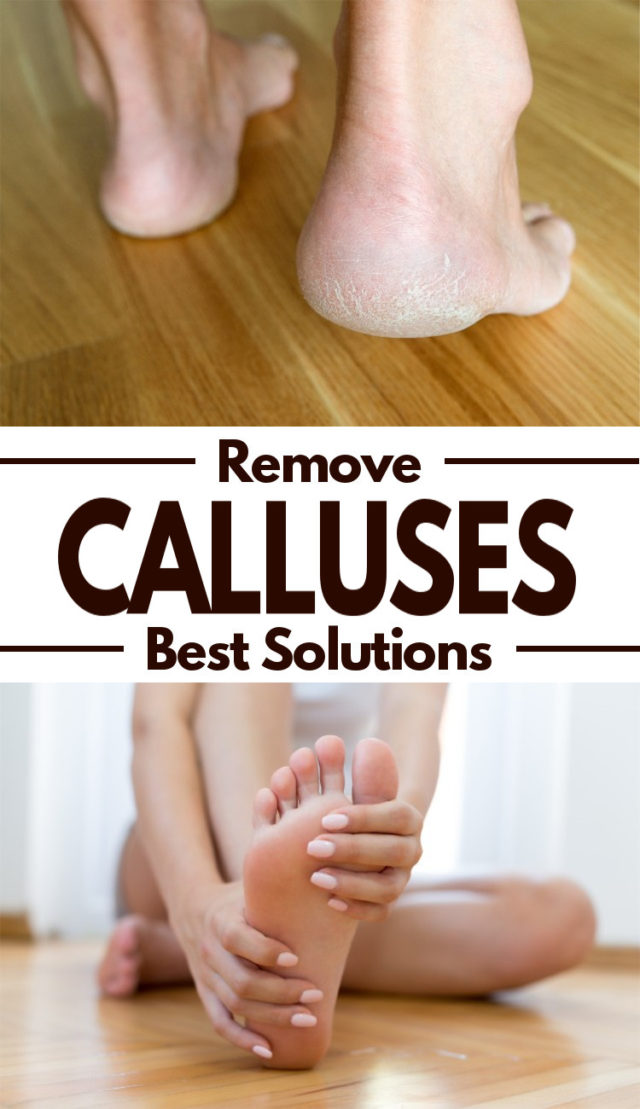 The Best Ways to Get Rid of Calluses | Fluster Buster